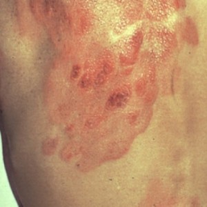 Cutaneous T-Cell Lymphoma CTCL - Part 1 - Next Steps in Dermatology