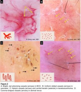 Practical Dermoscopy: Part 2 - Next Steps in Dermatology
