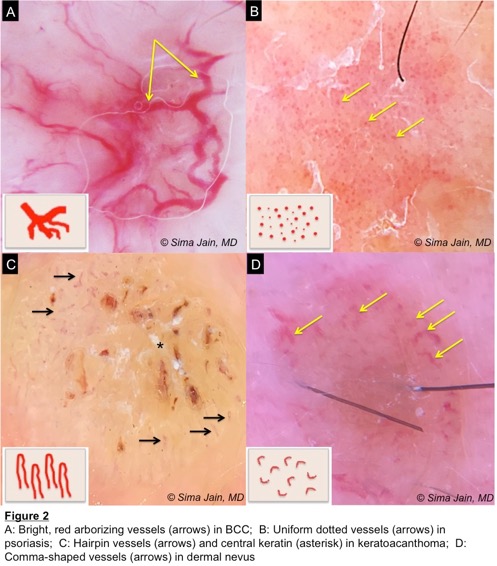Practical Dermoscopy: Part 2 - Next Steps in Dermatology