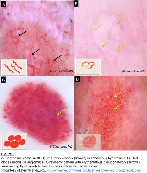 Practical Dermoscopy: Part 2 - Next Steps in Dermatology