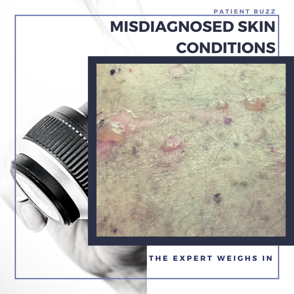 Patient Buzz Misdiagnosed Skin Conditions Next Steps In Dermatology