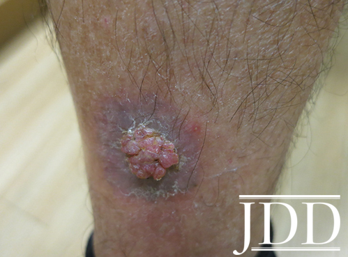 Blastomycosis-like Pyoderma Arising in Lichen Planus - A JDD Case ...