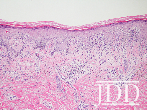 Blastomycosis-like Pyoderma Arising in Lichen Planus - A JDD Case ...