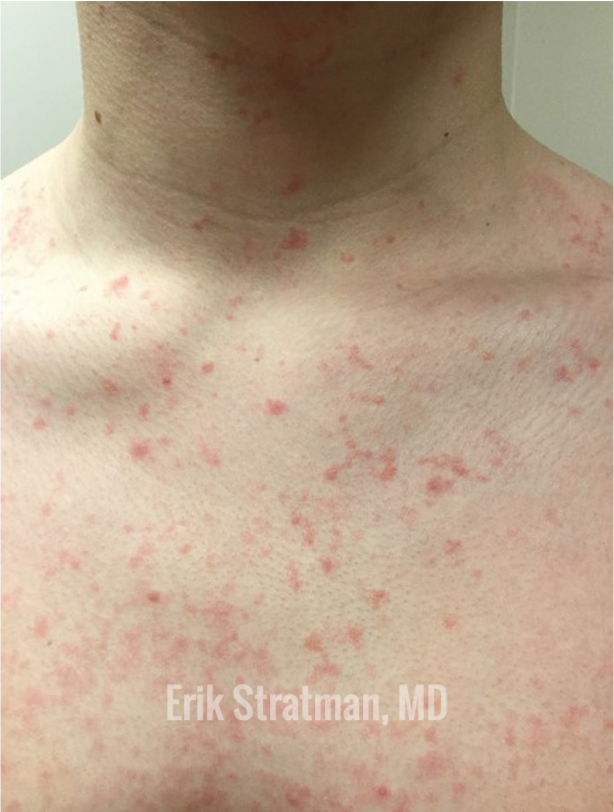 High-Yield Hitters: Cutaneous Manifestations of Systemic Disease - Next ...