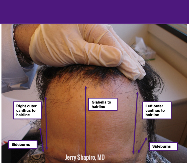 Lichen Planopilaris and Frontal Fibrosing Alopecia: Treatment Algorithms - Next Steps in Dermatology
