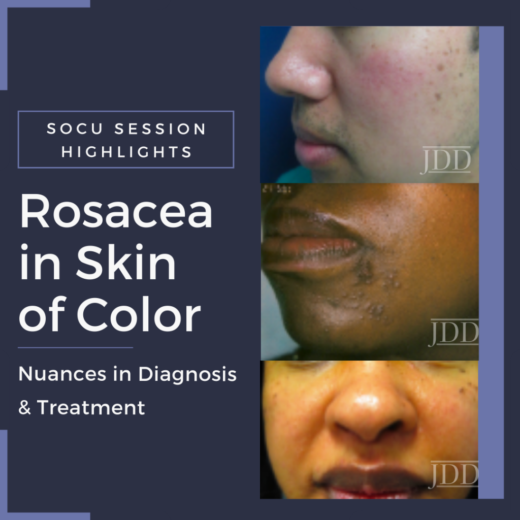 rosacea differential diagnosis Archives - Next Steps in Dermatology