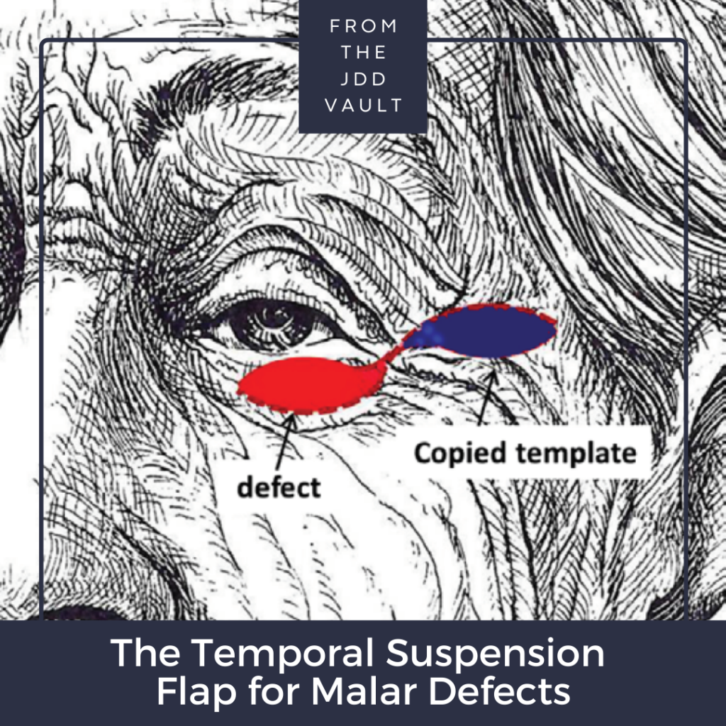 Temporal Suspension Flap for Malar Defects - Next Steps in Dermatology
