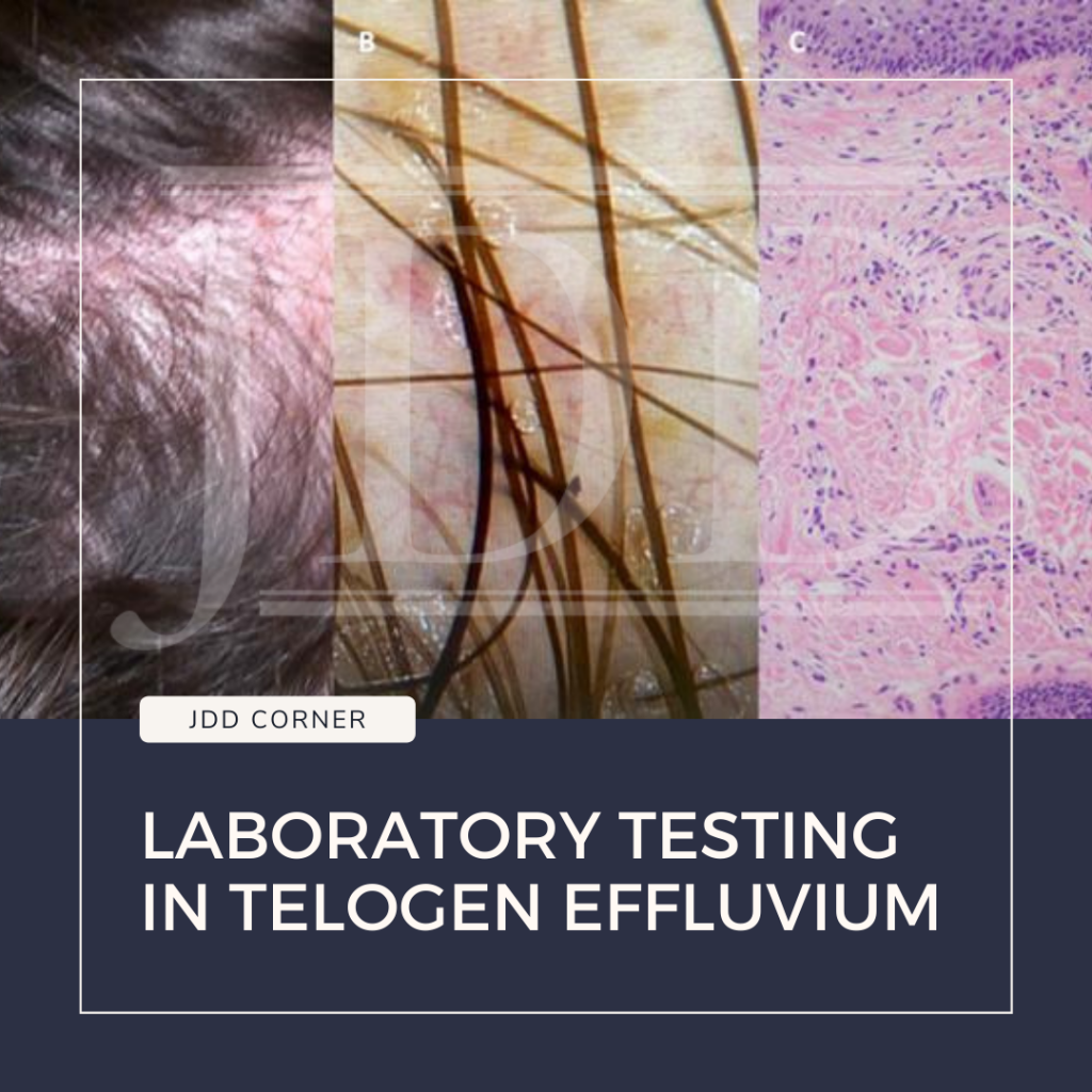 Laboratory Testing in Telogen Effluvium - Next Steps in Dermatology