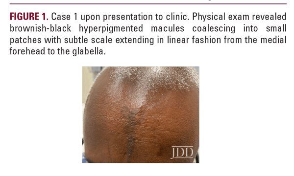 Acute Onset Linear Lichen Planus Pigmentosus of the Forehead: A Case ...