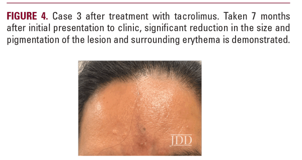 Acute Onset Linear Lichen Planus Pigmentosus of the Forehead: A Case Series - Next Steps in ...