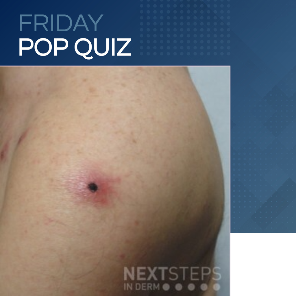 Friday Pop Quiz 1/26/2024 - Next Steps in Dermatology